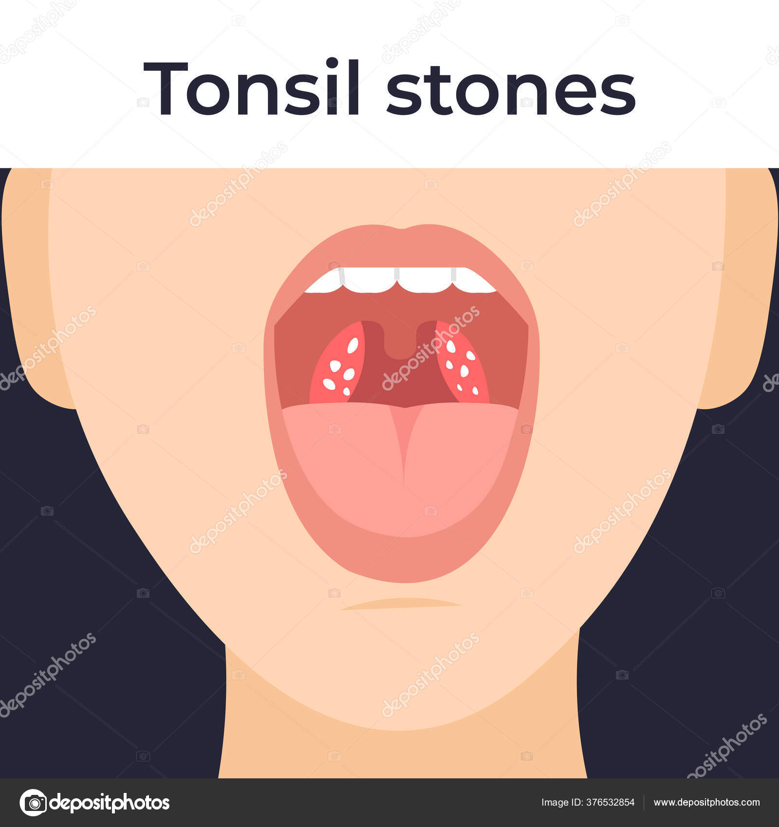 Schwere Mandelsteine Tonsil Stones Simulator – Apps Bei Google Play