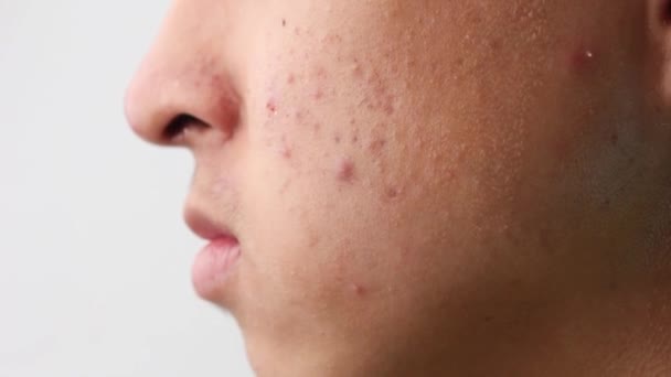 Close Side Face Asian Teenage Guy Acne Skin Problems Health — Stock ...
