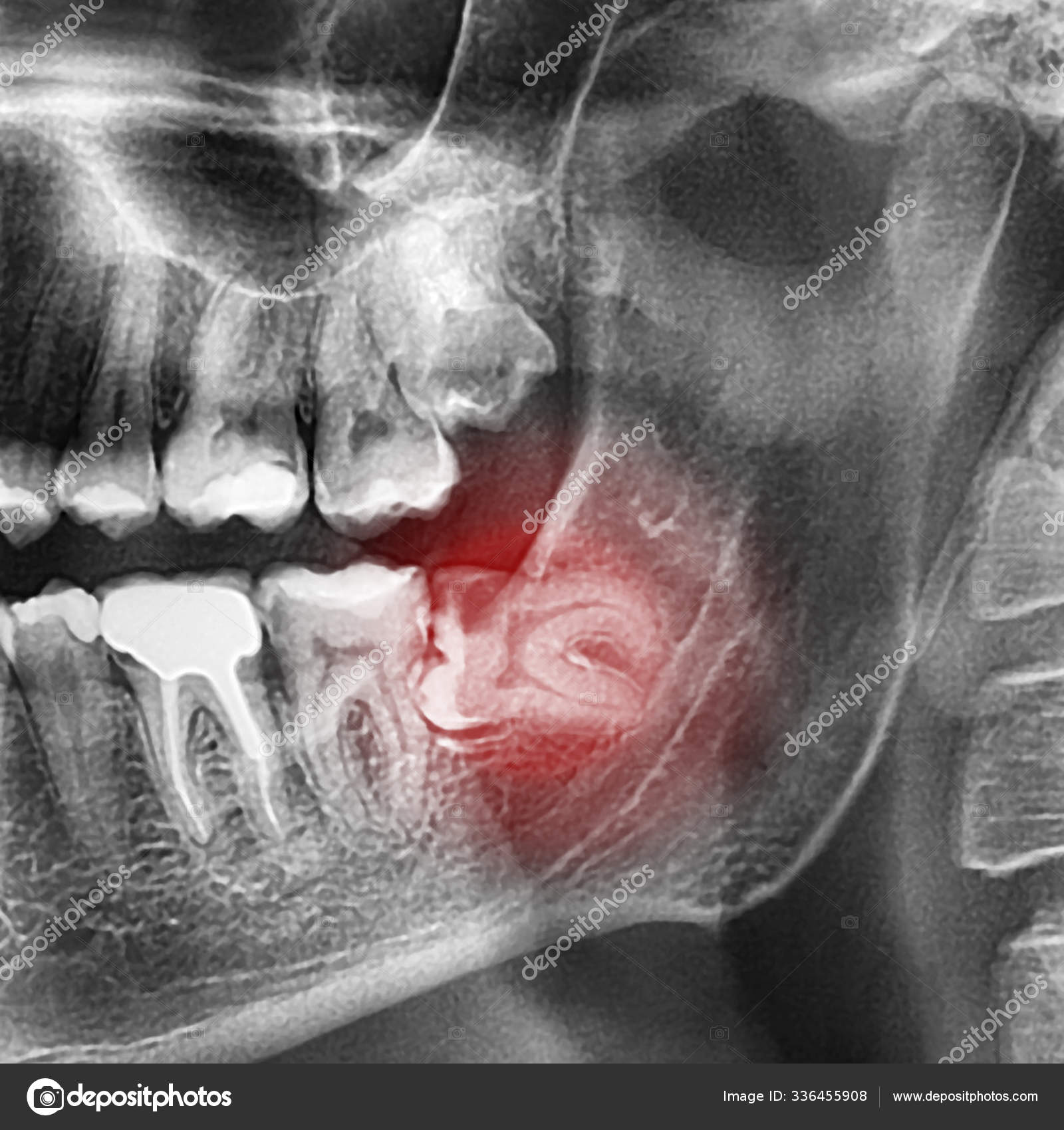 Radiographs Teeth Orthopantomogram Dentition Lower Wisdom Teeth Eighth ...