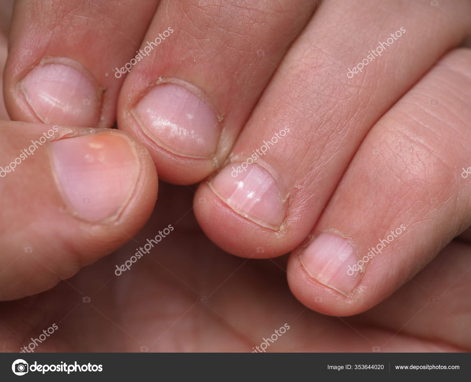 Zinc Deficiency Nails Zinc Deficiency Nails