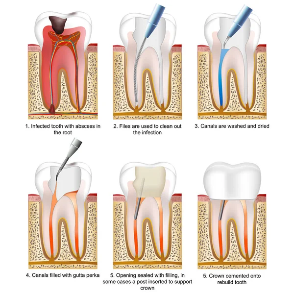 100,000 Root canal therapy Vector Images | Depositphotos