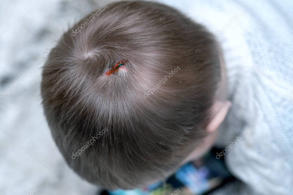 Laceraciones en la cabeza por accidente. Joven con traumatismo craneal 2023