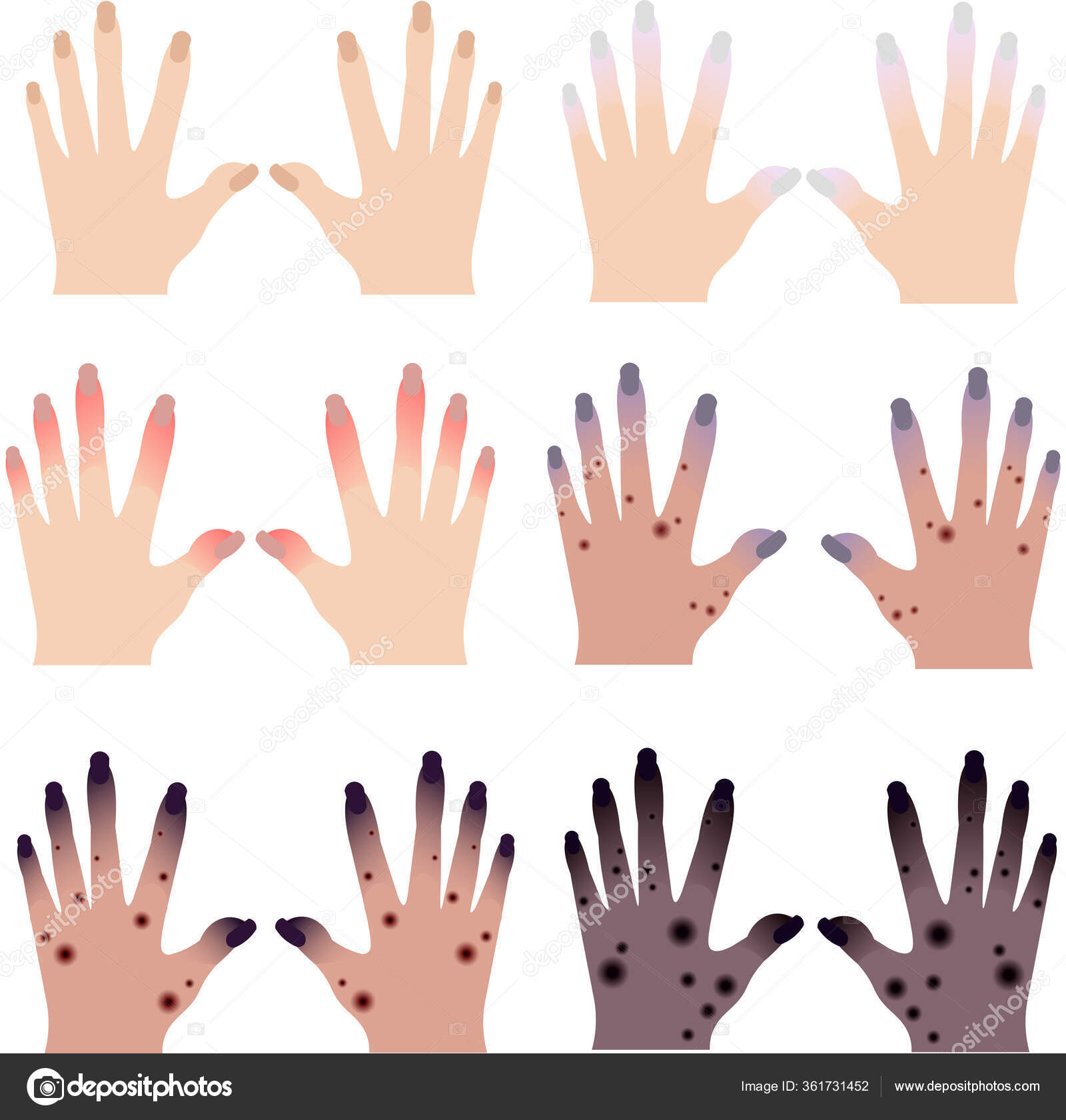 Sore Hands Skin Diseases Ulcers Rashes Gangrene Necrosis Stage ...