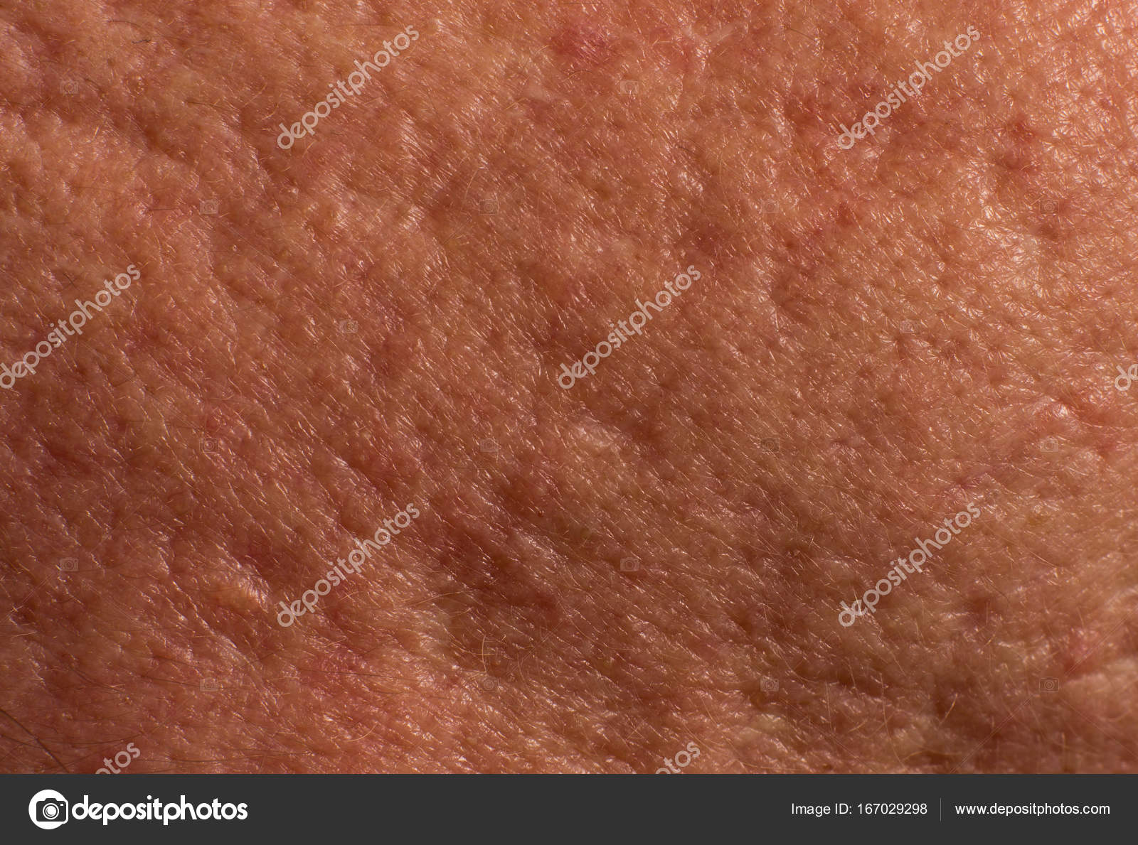 Skin with acne scars — Stock Photo © budabar #167029298