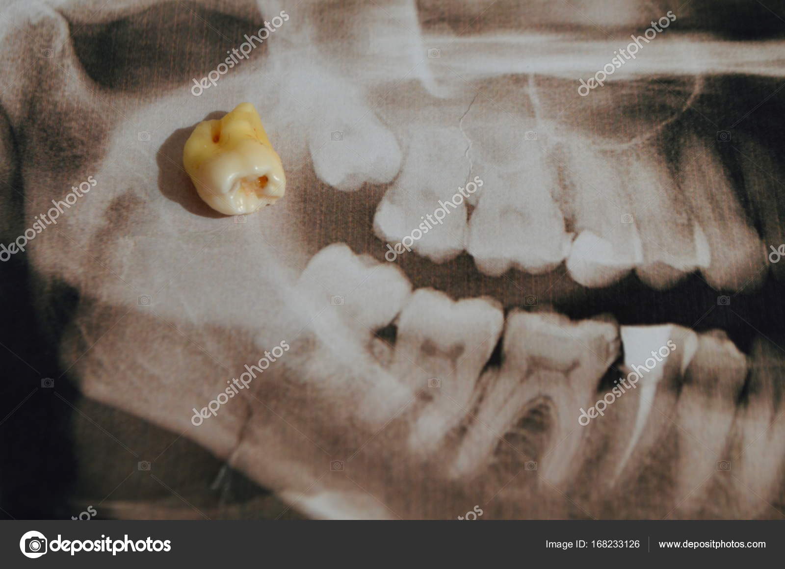 Panoramic picture of supercomplete teeth. x-ray Stock Photo by ©YuliyaM ...
