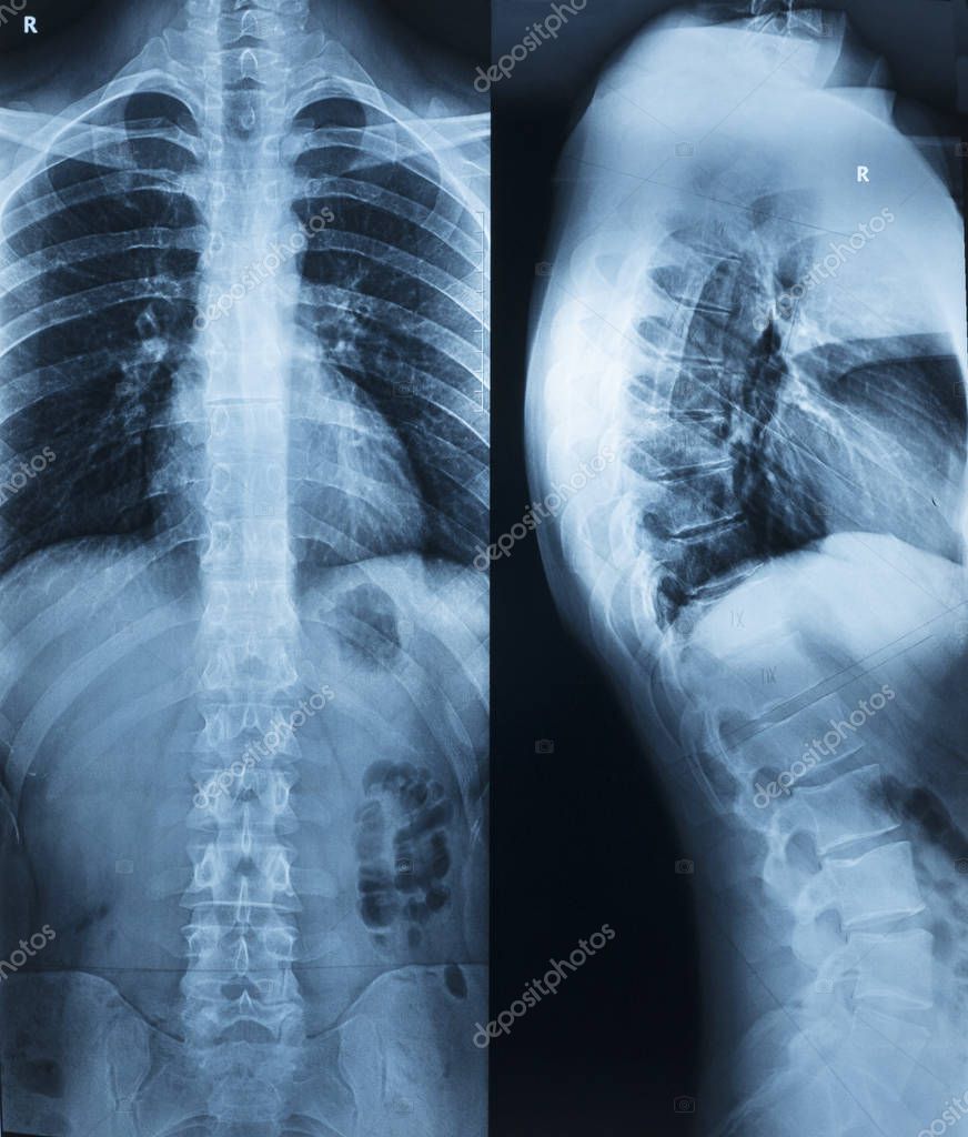 Radiografía de la columna vertebral de un hombre con una escalera en ...