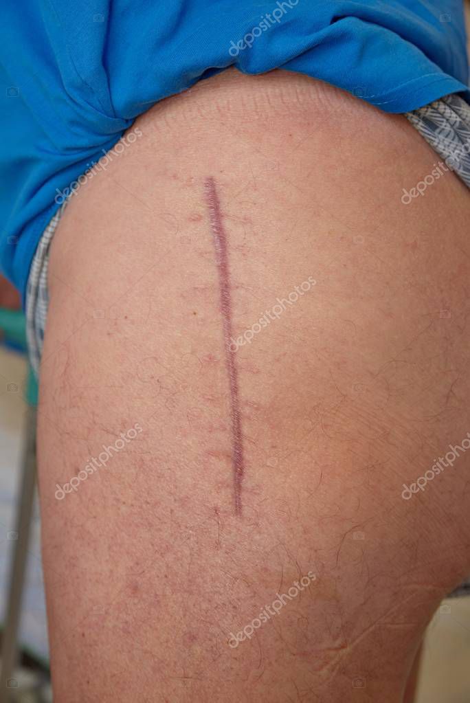 Cicatriz de un año tras cirugía de articulación de cadera. Sustitución ... Cicatriz de un año tras cirugía de articulación de cadera. Sustitución ...