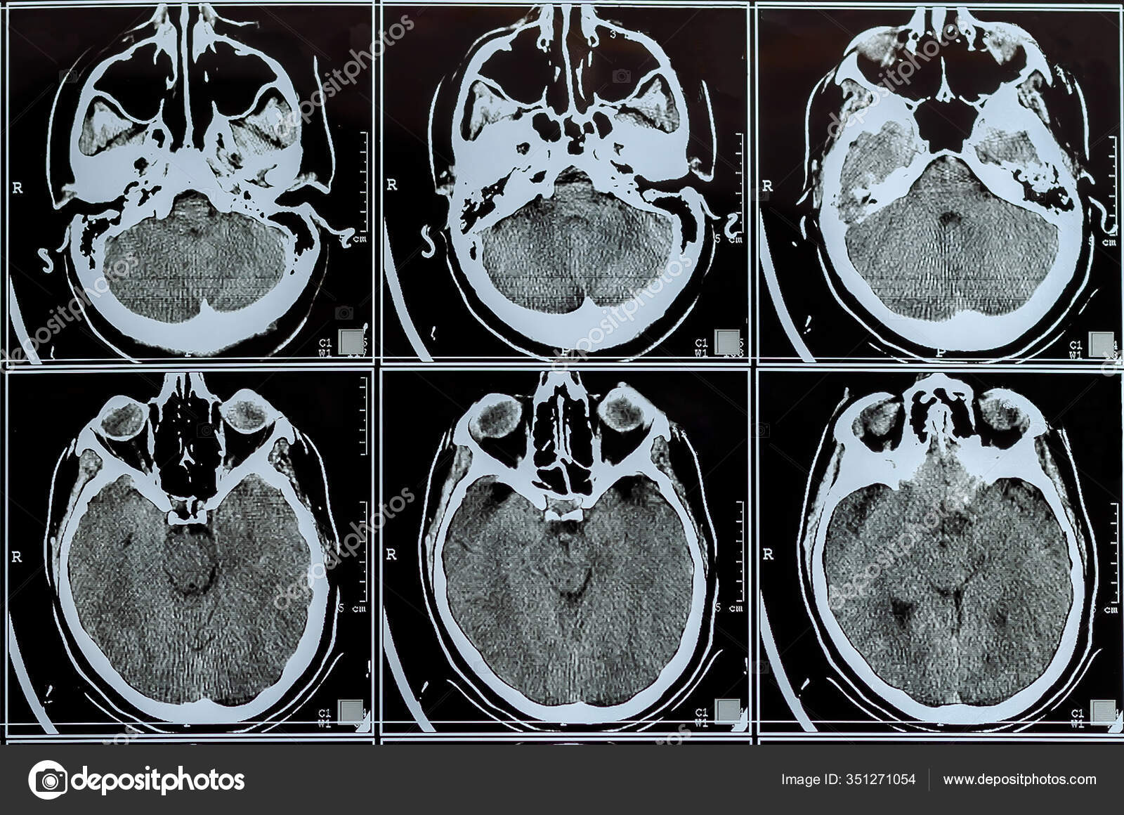 Mrt Des Gehirns Mrt Gehirn Scan Oder Röntgen Neurologie Menschlicher ...