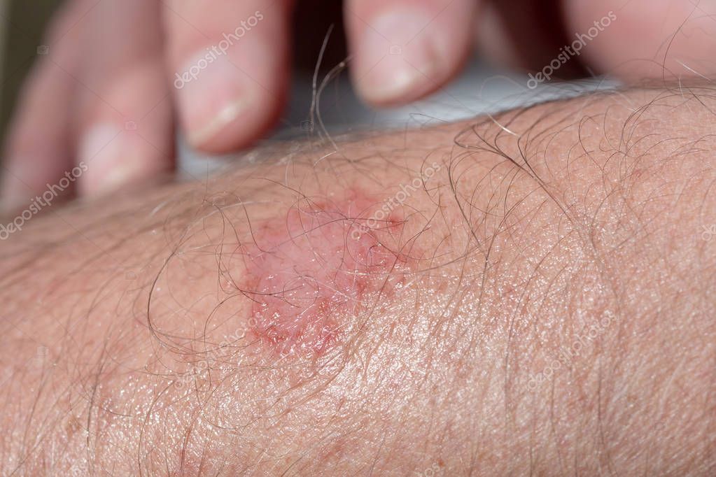 eccema en el brazo de un hombre 2024