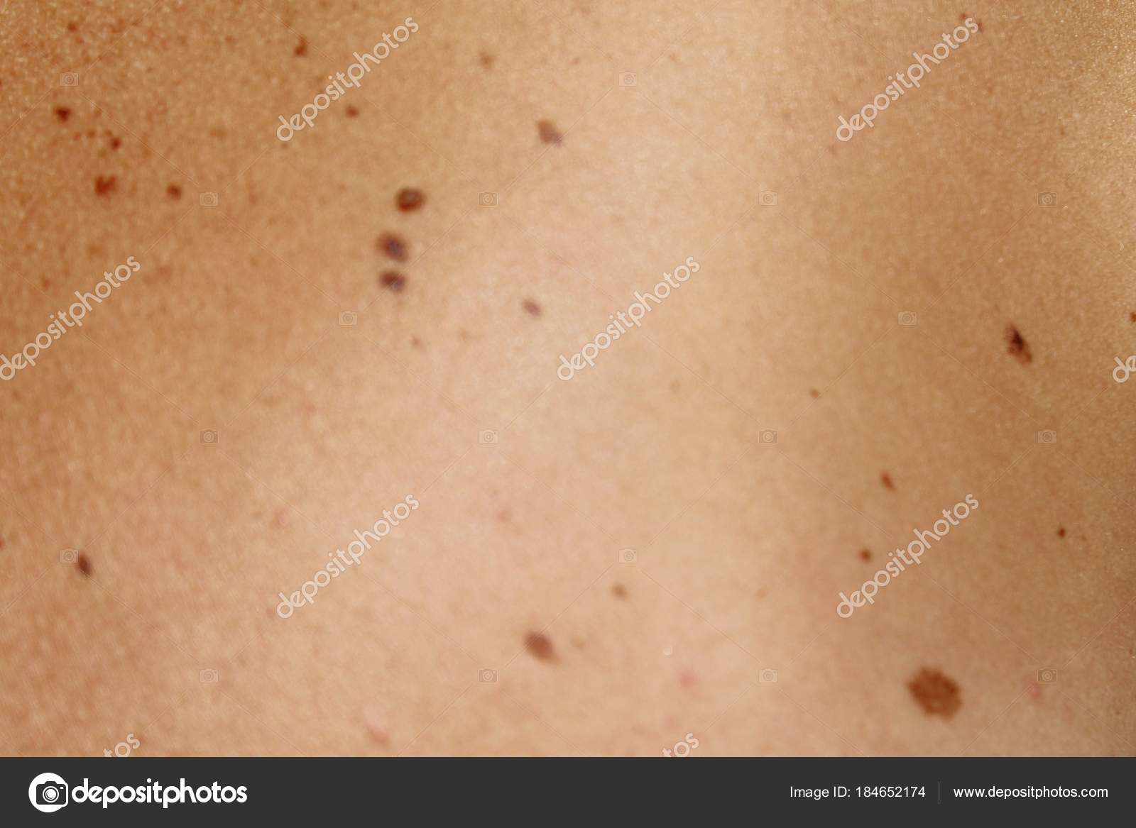 Close Human Skin Naevus Stock Photo by ©marcobir 184652174