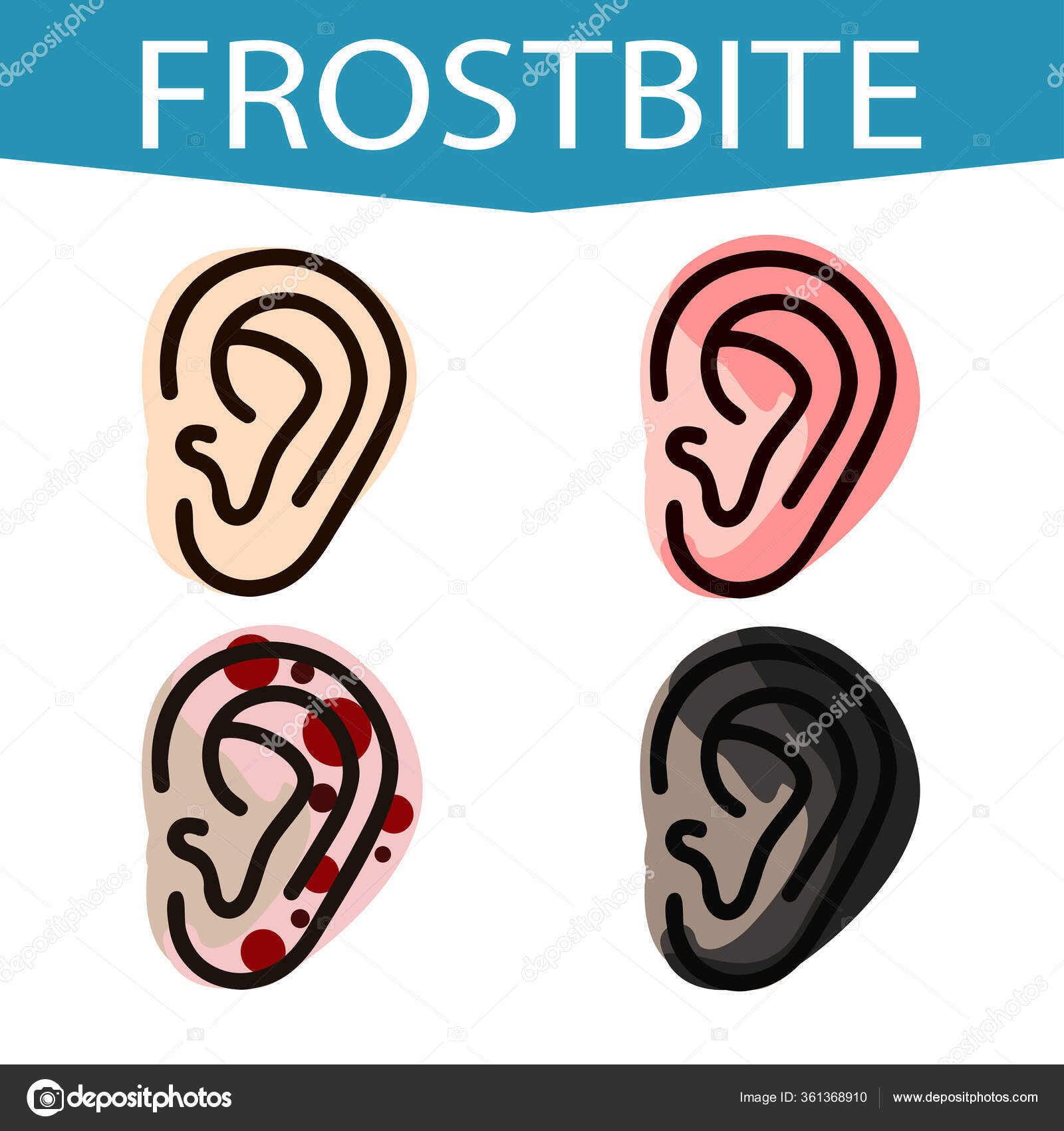 Frostbite Stages Frostbite Grass Effects Hypothermia Ear Roubini Vector ...