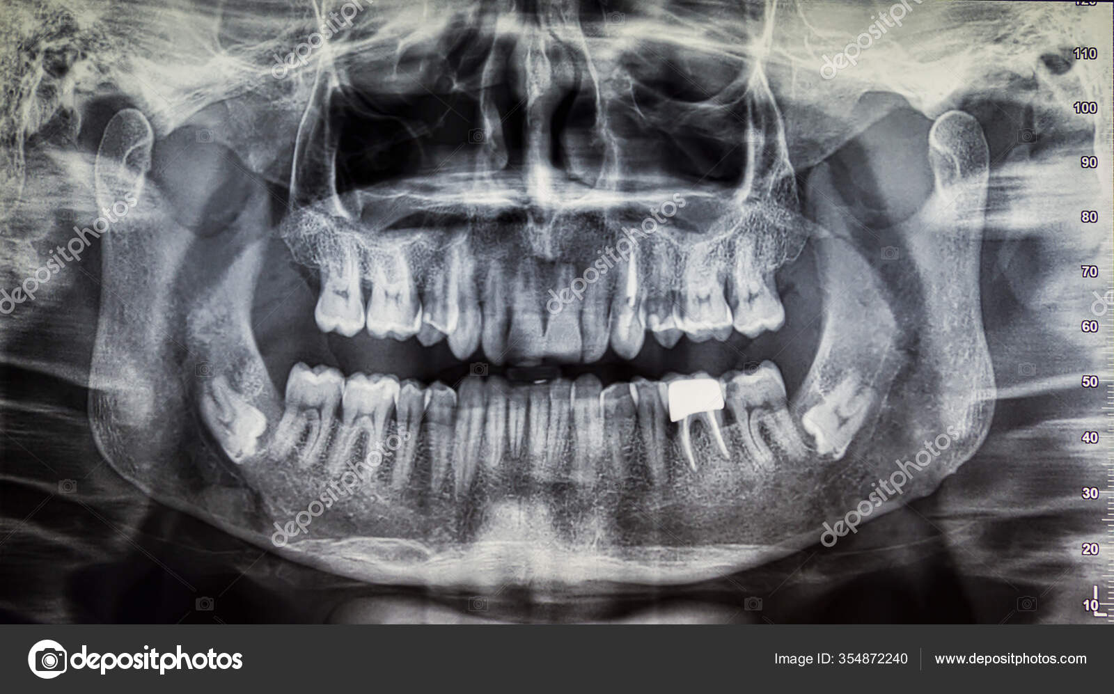 Orthopantomography of an adult patient,digital radiographic acquisition ...