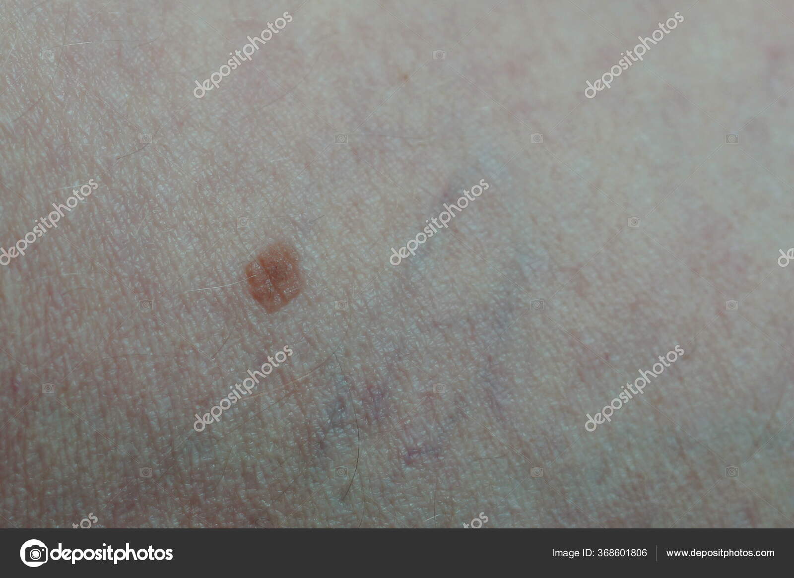 Carcinome Basocellulaire Cancer Bénin Peau Cancer Basocellulaire Sur ...