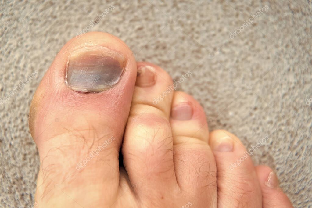 lesión en el dedo. moretones y tratamiento de trauma. intervención ...