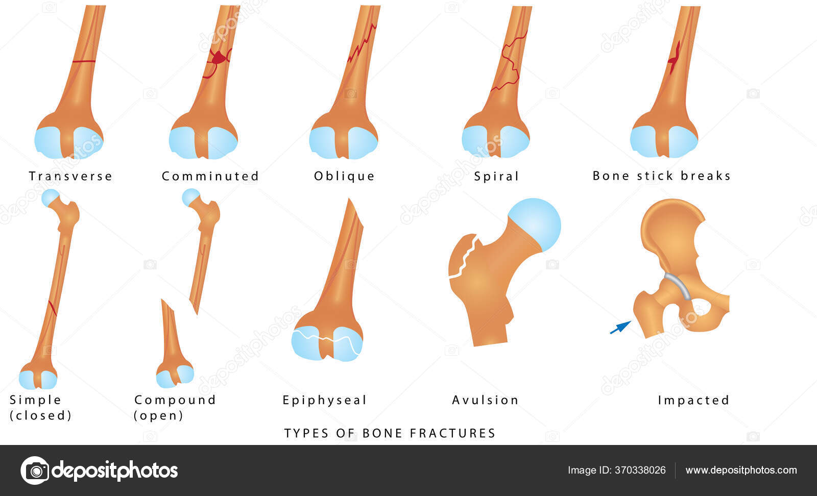 Types Fractures Osseuses Différents Types Fractures Illustration ...