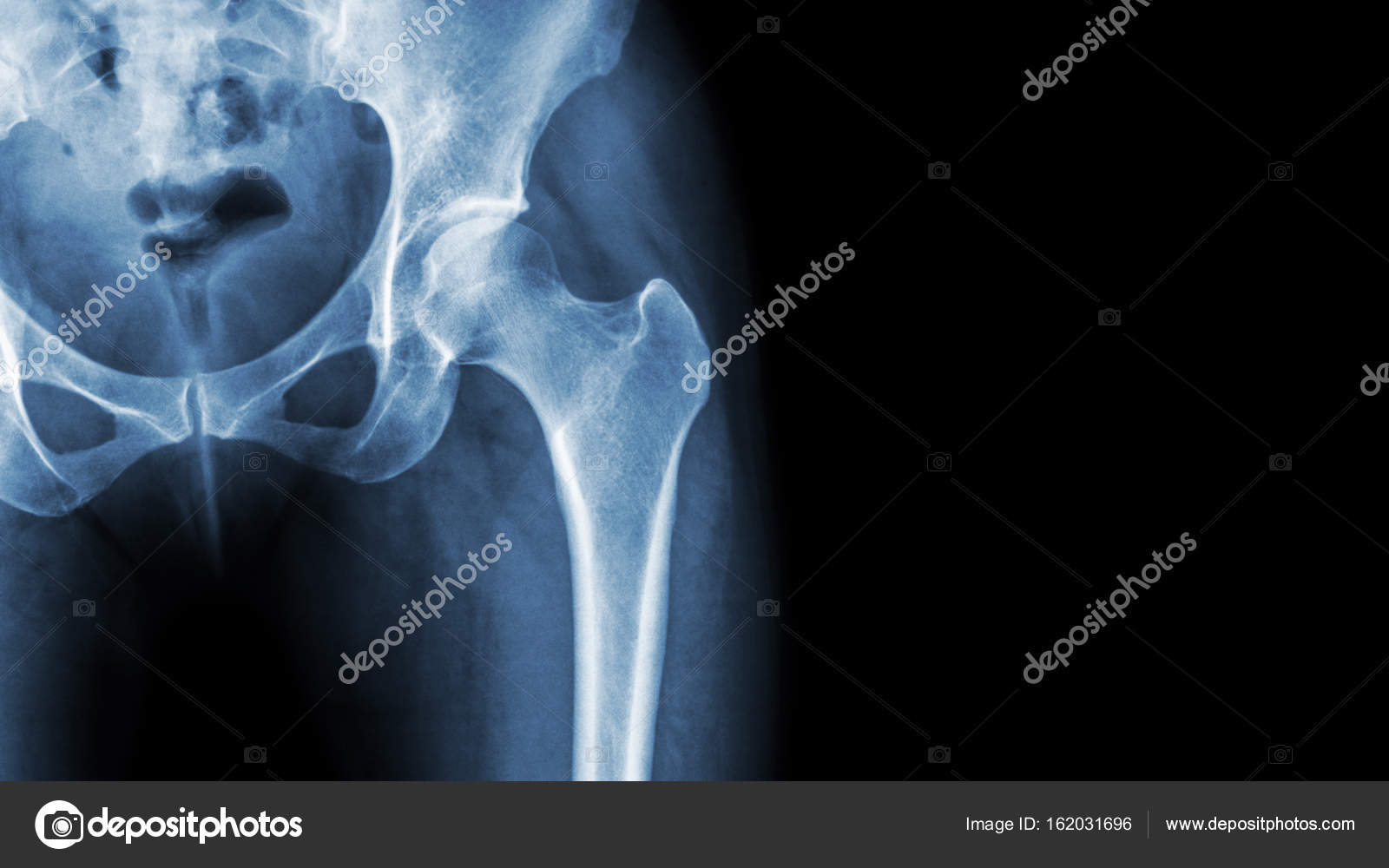 Fotos de Rayos X pelvis normal y articulación de la cadera. Zona en ...