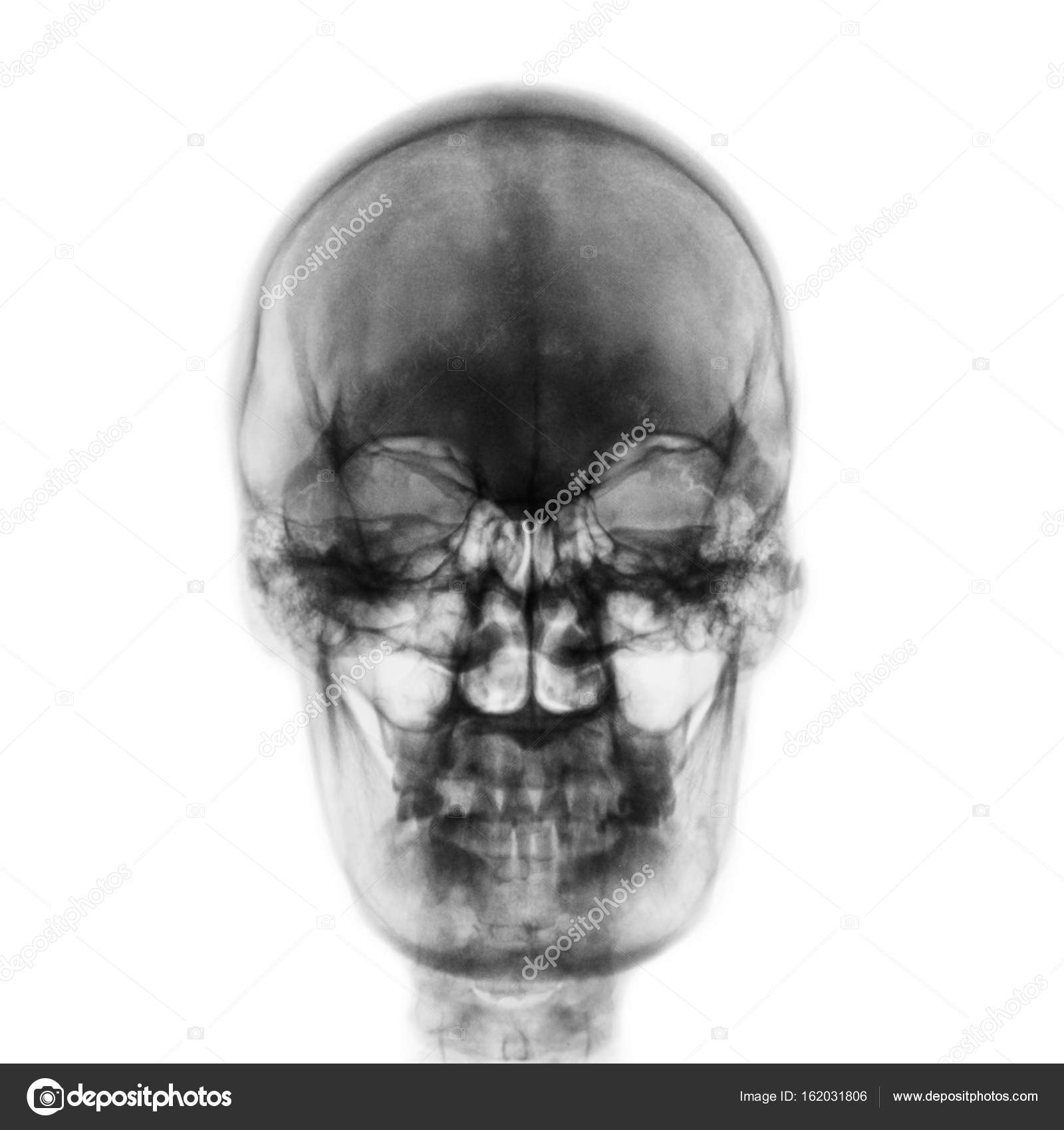 X Ray Skull Front