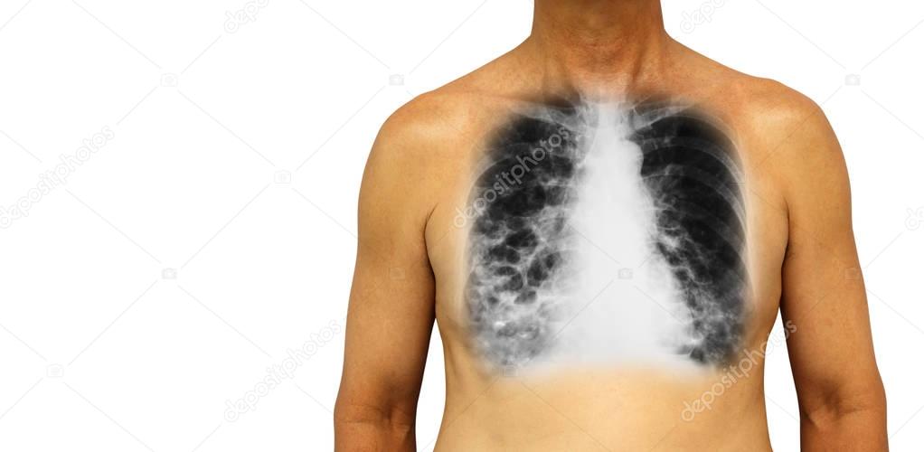 Bronquiectasias. El tórax humano con radiografía de tórax muestra ...