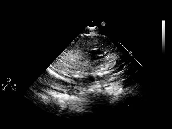 Syndrome de la valve mitrale disquette fotos de stock, imágenes de ...