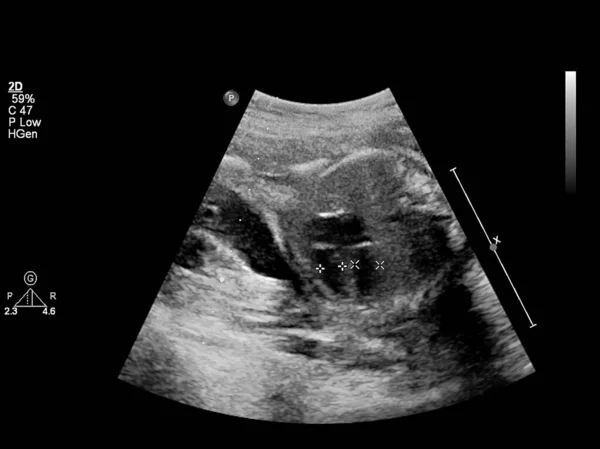 Roberts syndrome Stock Photos, Royalty Free Roberts syndrome Images ...