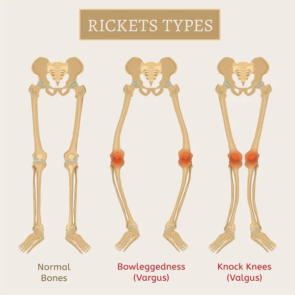 Knock knee Vector Art Stock Images | Depositphotos