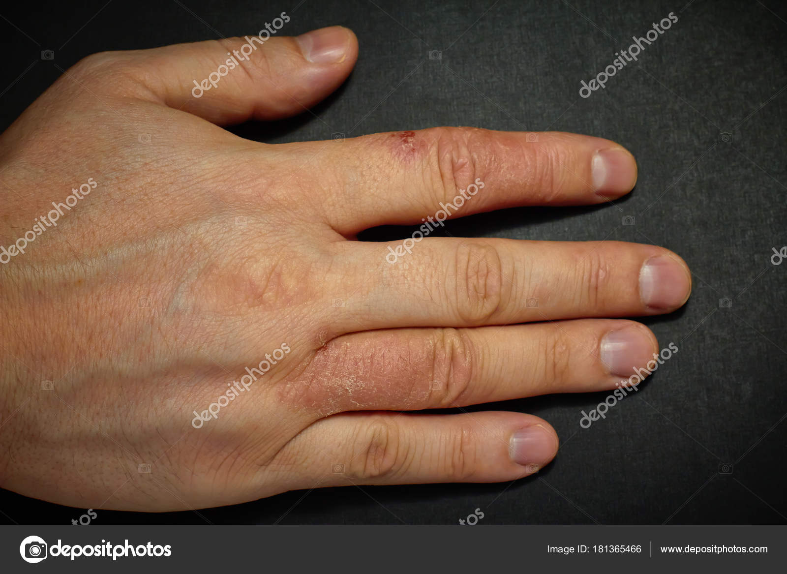 Mild Dermatitis Herpetiformis On Hands