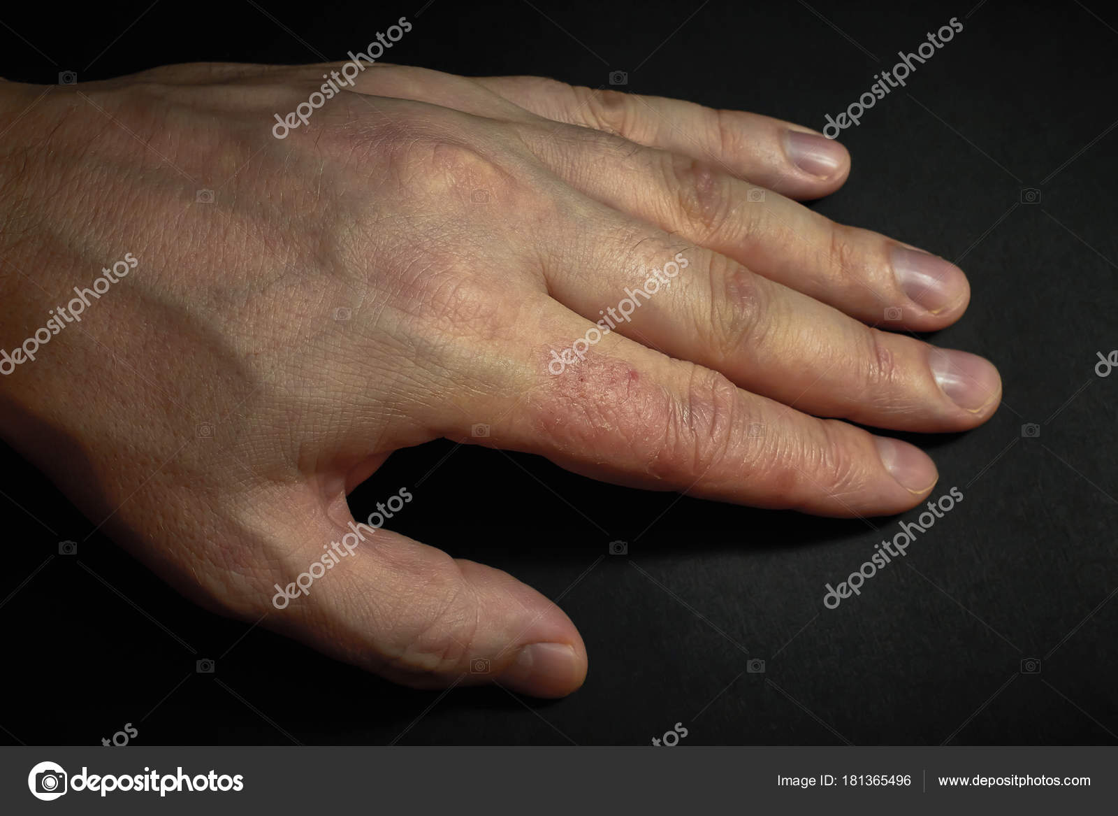 Dermatitis de manos. Eczema de mano — Foto de stock © d19p76 #181365496