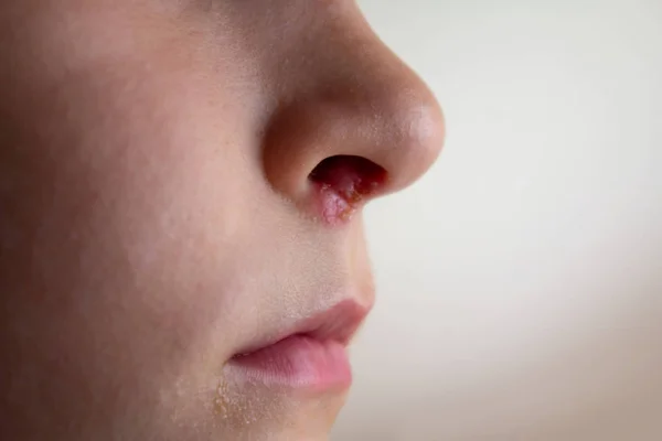 The Herpes virus on mouth of young woman Stock Photo by ©maksim_e 191474712