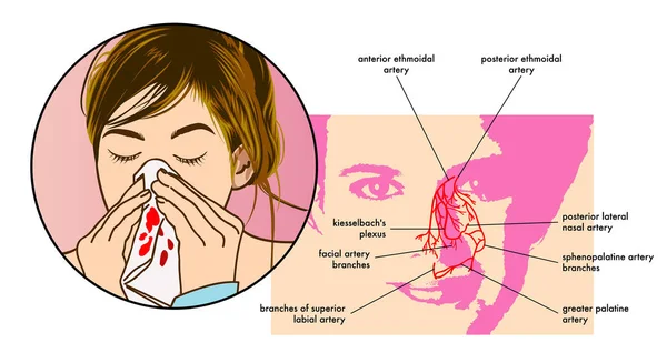 Epistaxis Vector Art Stock Images | Depositphotos