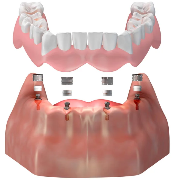 ᐈ Complete dentures stock images, Royalty Free complete denture ...