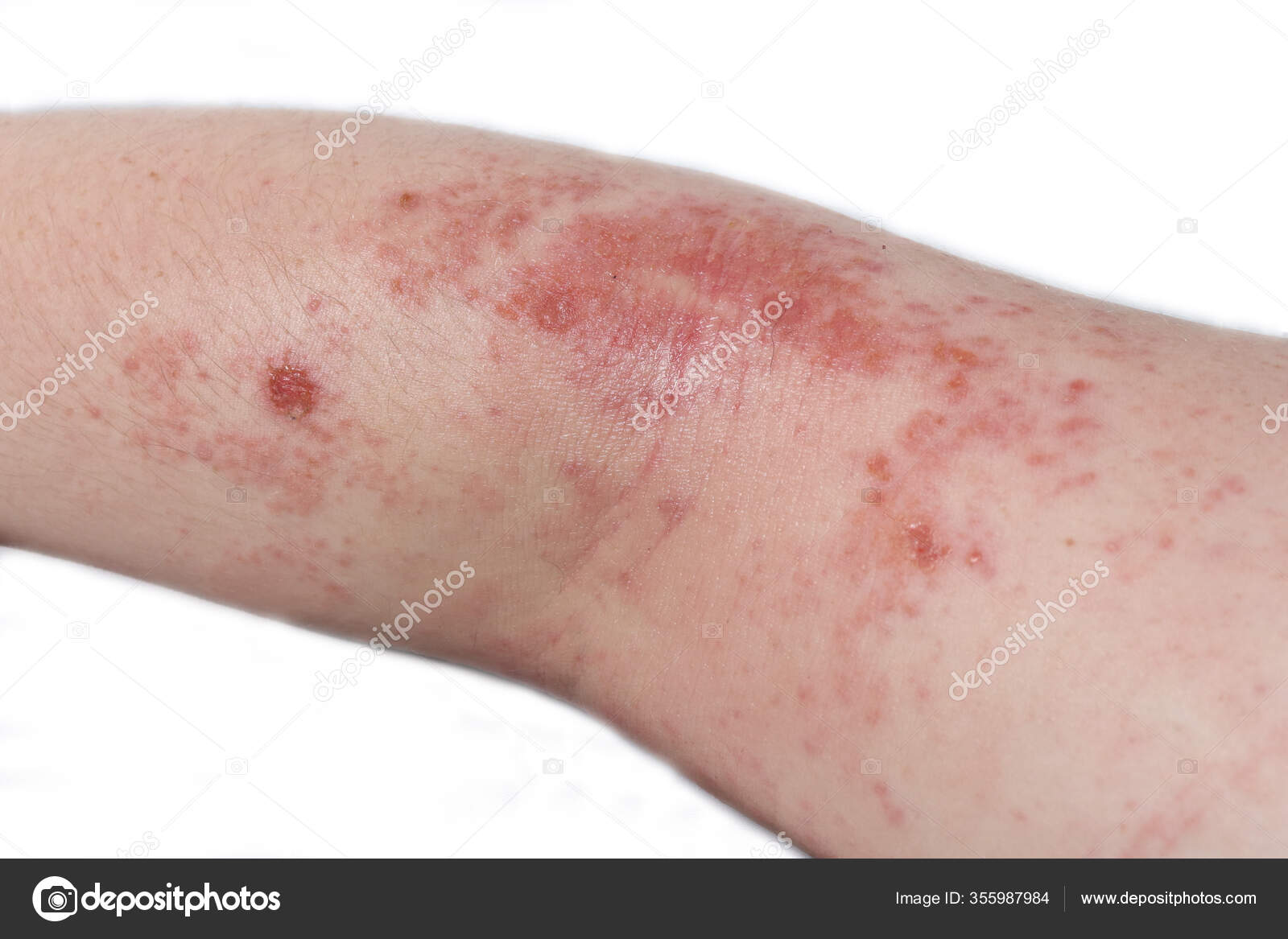 Impetigo On Arm