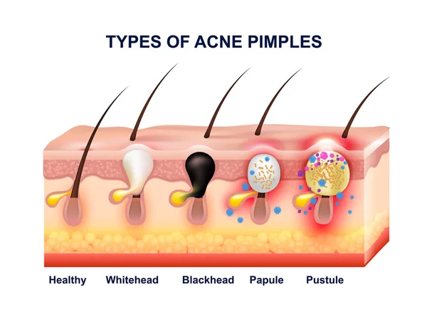 Types Of Acne Chart