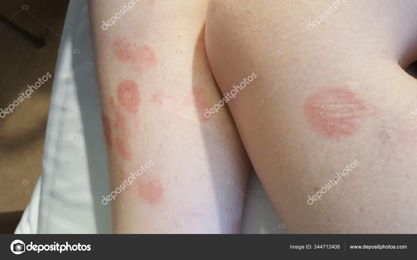 Erythema Multiforme Bilder Altmeyers Enzyklopdie