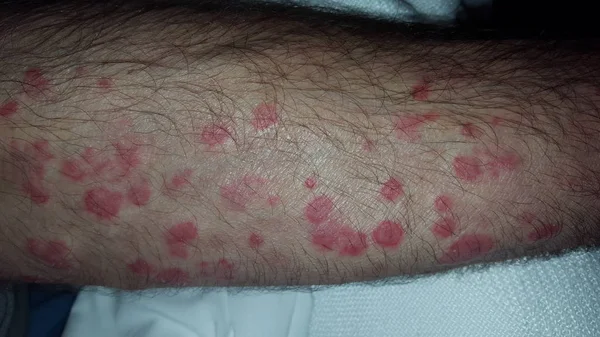 Erythema multiforme Stock fotók, Erythema multiforme Jogdíjmentes képek ...