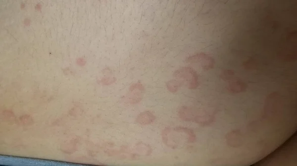 Erythema multiforme annular erythematous targetoid skin lesions Stock ...
