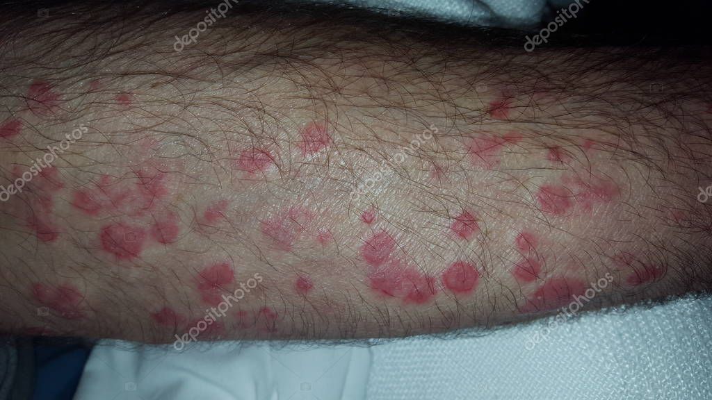 Eritema multiforme eritematoso anulare lesioni cutanee targetoidi ...