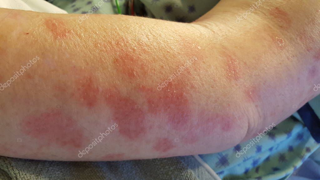 Erythema Multiforme Annular Erythematous Targetoid Skin Lesions Stock ...