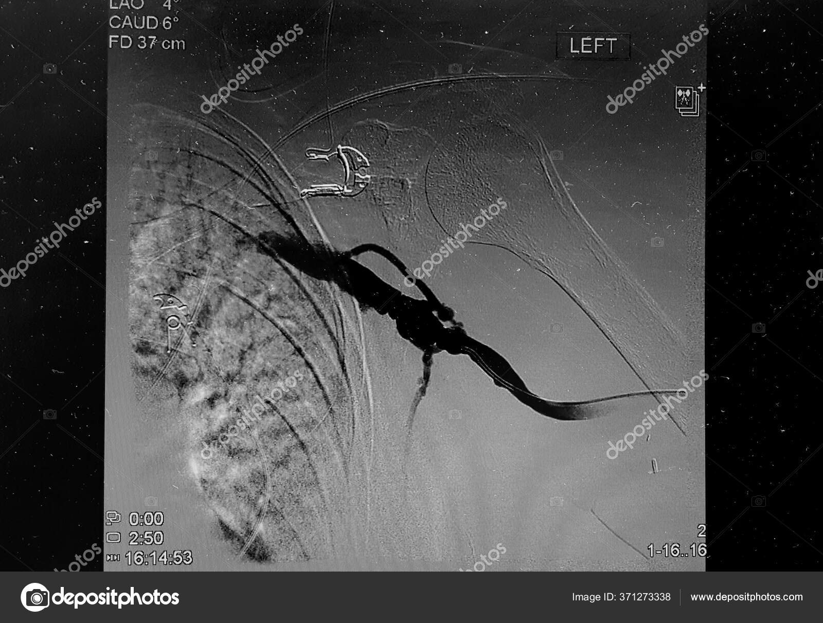 Dialysis shunt angiography image - performed for stenosis — Stock Photo ...