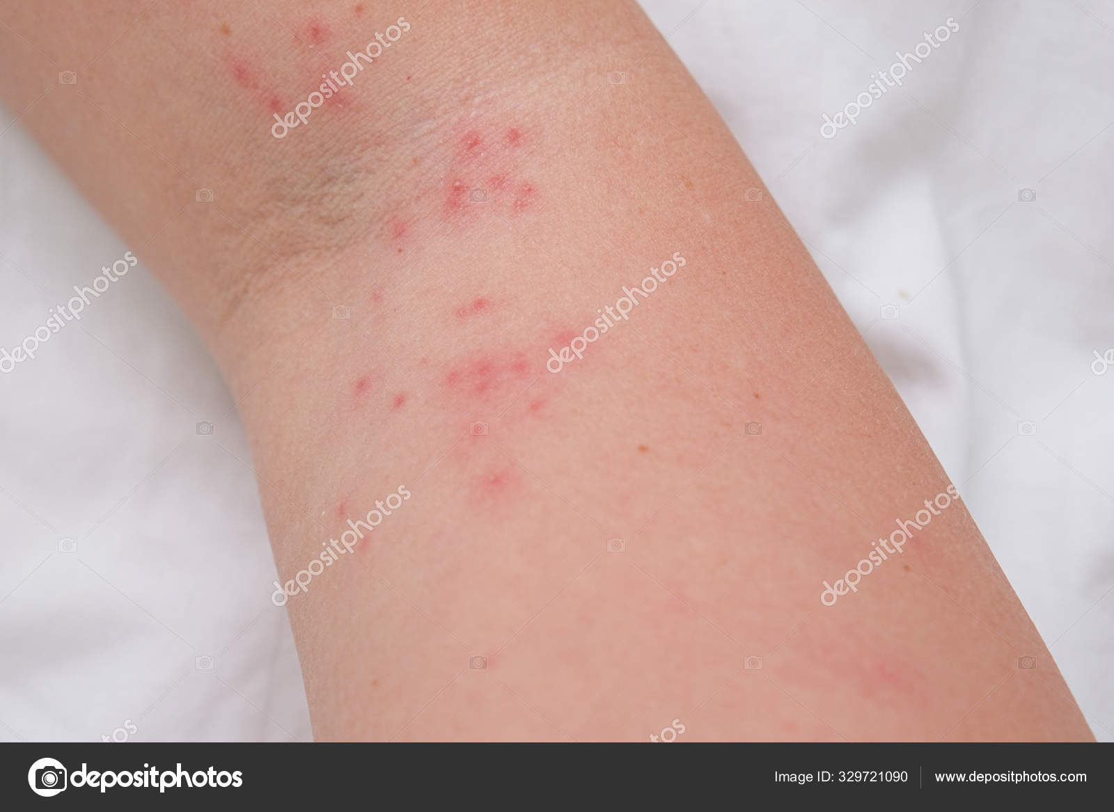 Itchy Bumps On Arms