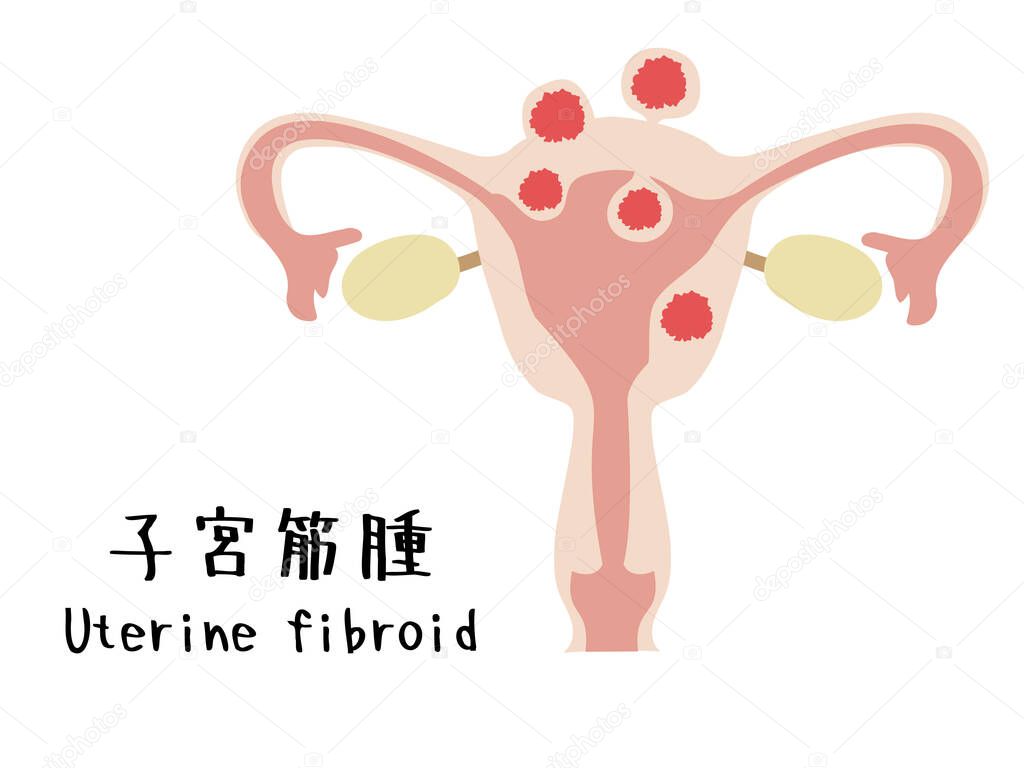 Ilustración que muestra tipos de fibromas uterinos 2022