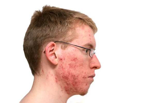 Dermatitis seborreica images libres de droit, photos de Dermatitis ...