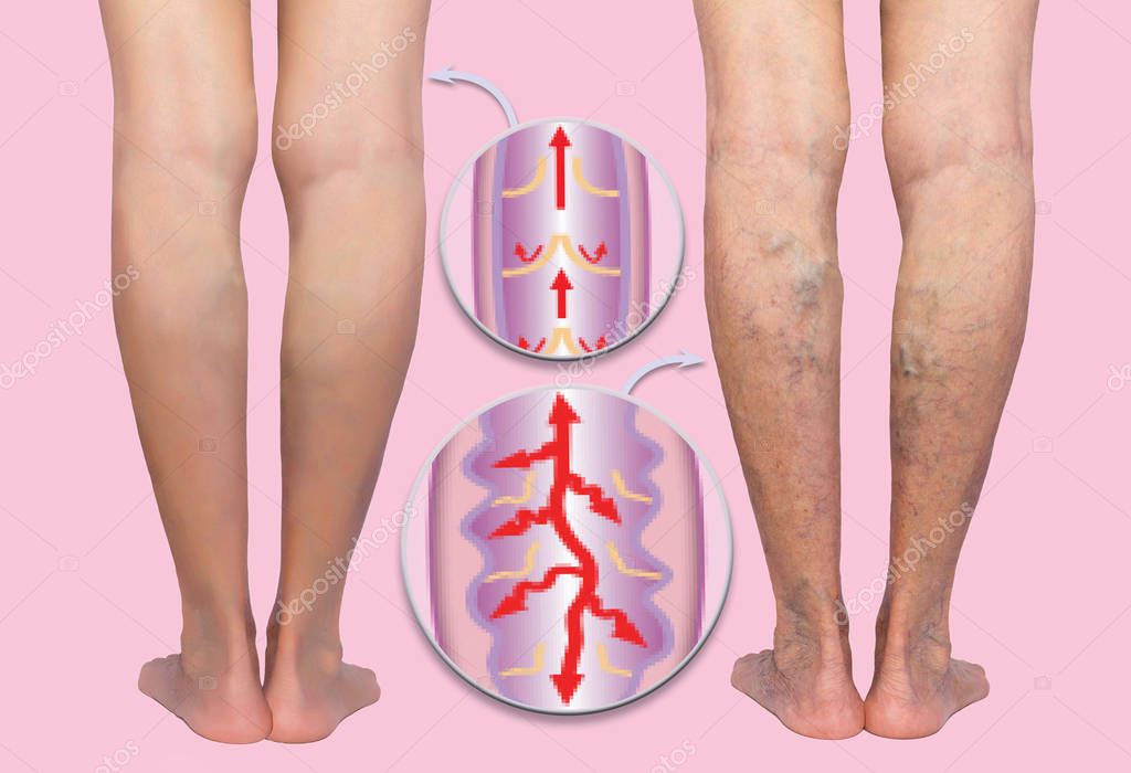 Venas Varicosas Las Piernas Una Mujer Mayor Estructura Las Venas — Foto ...