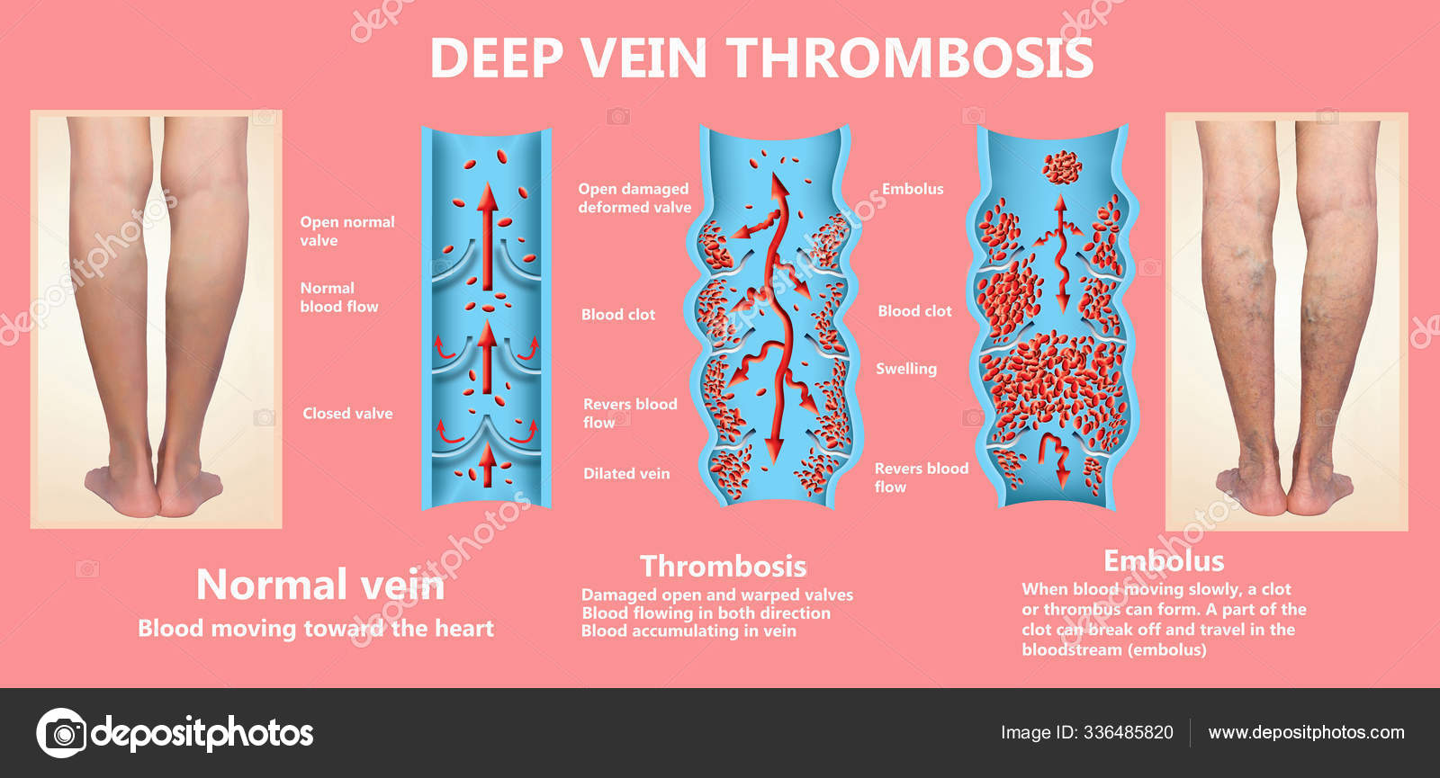 Thrombosis Normal Blood Flow Blood Clot Formation Clot Travels ...