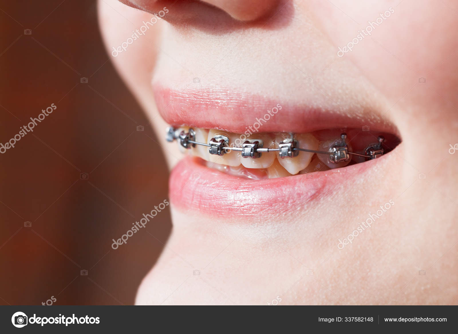 Side View Dental Braces Teeth Upper Jaw Orthodontic Treatment Stock ...