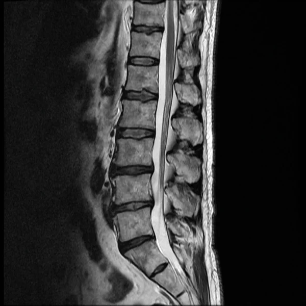 Mri Lumbar Disc Herniation Stock Photo by ©PantherMediaSeller 338301344