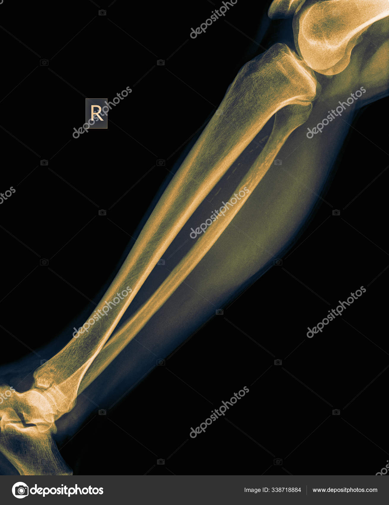 Broken Tibia X Ray