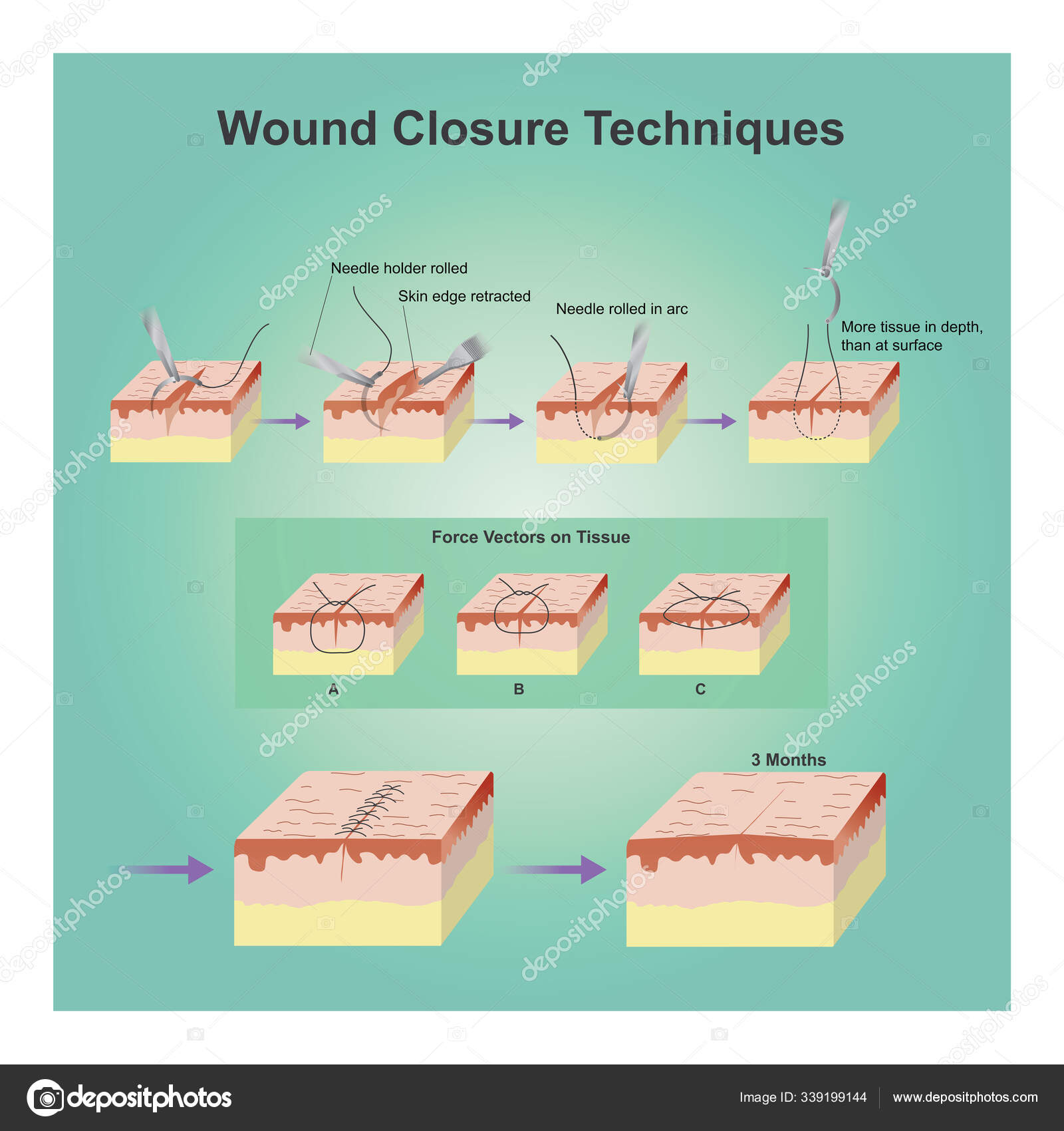 Wound Type Injury Which Happens Relatively Quickly Which Skin Torn ...