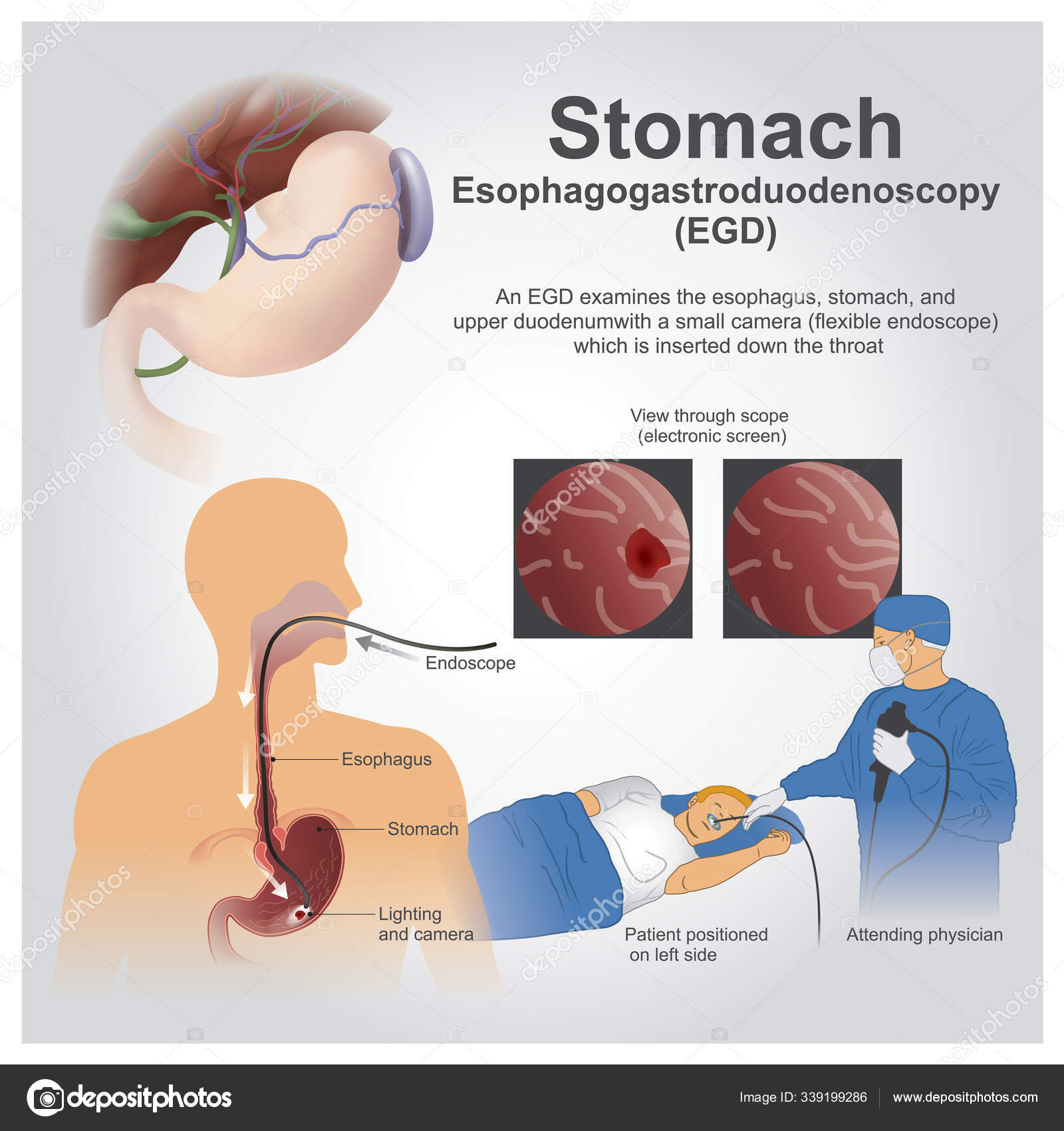 Esophagogastroduodenoscopy Also Called Various Other Names Diagnostic ...