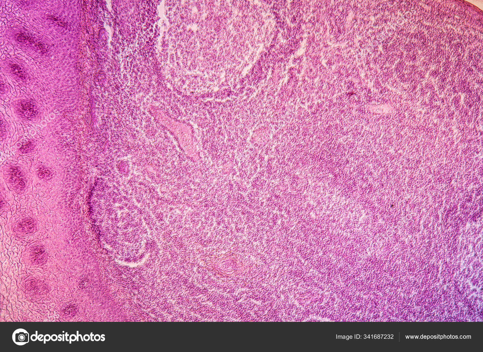 Tonsillitis Diseased Tissue 100X — Stock Photo © PantherMediaSeller ...