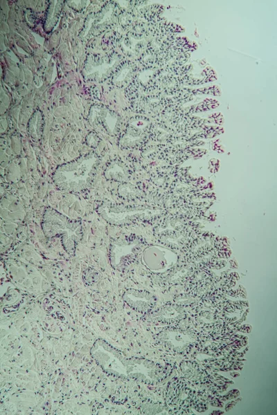 Lesiones granulomatosas Stock Photos, Royalty Free Lesiones ...